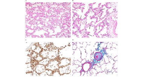Typical Capillary Proliferation Cp And Small Vessel Vasculopathy In