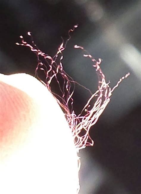 Morgellons Face Treatment