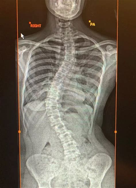 Barbie Scoliosis Doll Praised By Woman Born With Curved Spine Who