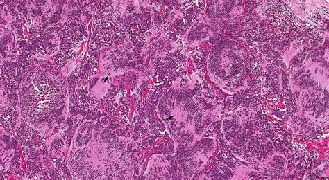 Medulloblastoma Pathology Outlines