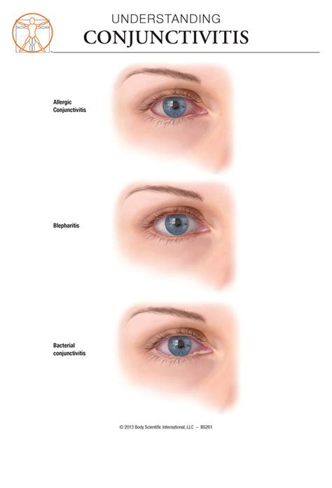 Conjuntivitis Anatomical Wall Chart Bsi Catalog