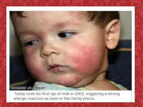 Hypersensitivity Pptx