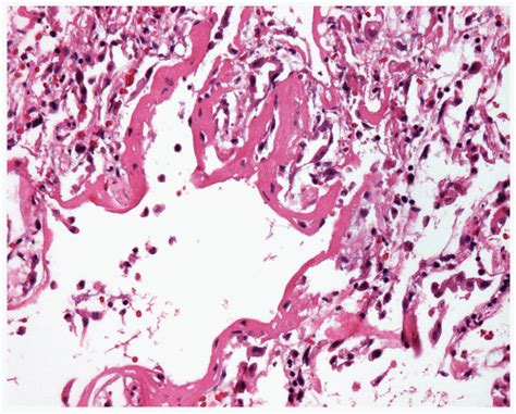 Diffuse Alveolar Damage Basicmedical Key