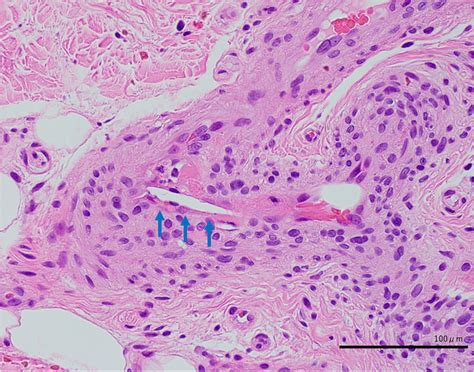 Histopathology Of The Palpable Purpura Which Exhibited A Cleft In A Download Scientific
