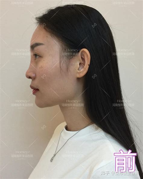 10年做5次鼻子！！！到底该如何规避鼻整形的那些坑！ 知乎