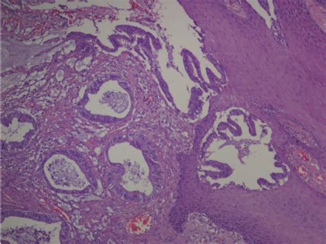 Microscopic Image Cystic Tumoral Tissue With Atypical Cells And