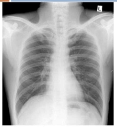 Radiology Pictureschest Flashcards Quizlet