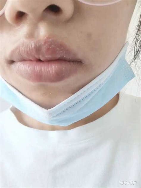 他克莫司治疗过敏性唇炎如何使用？ 知乎