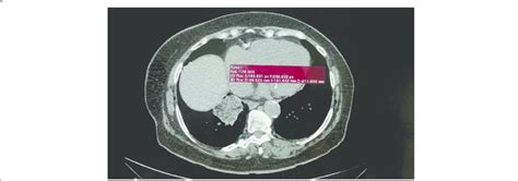 Thoracic CT At The First Medical Consultation Download Scientific Diagram
