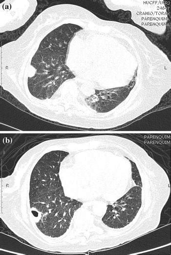 A Thoracic Computed Tomography Ct Scan Showing A Subpleural Nodule