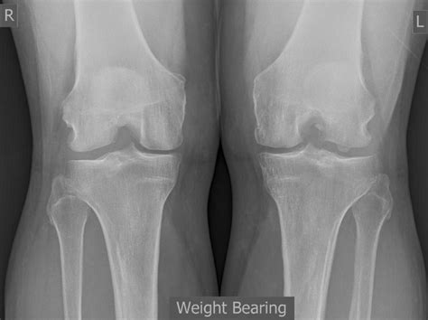 Subchondraler Osteophyt Pacs