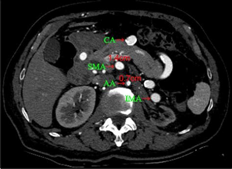 Extreme Compensatory Dilatation Of The Splanchnic Artery Caused By
