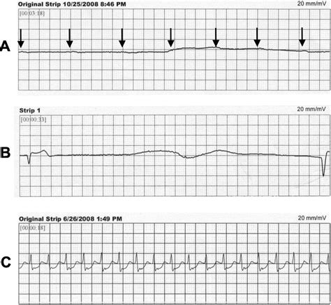 Clinical Utility Of A Novel Wireless Implantable Loop Recorder In The