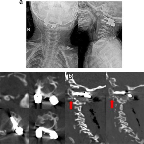 A Postoperative Cervical X Ray B A Postoperative Cervical Ct Scan