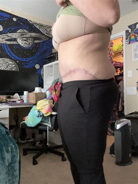 Swelling Or Getting Bigger 4 Months Post Op R Tummytucksurgery