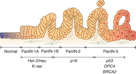Pancreatic Cancer Clinical Tree