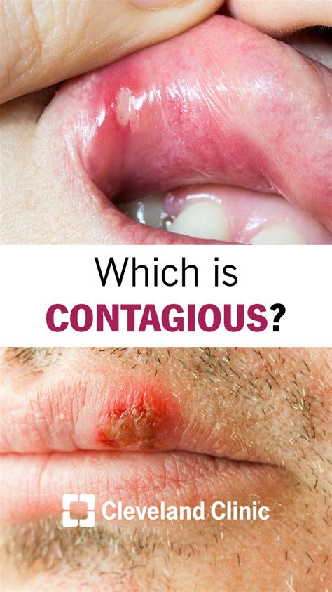 How To Cover Up A Cold Sore On Your Lip Nikki Salcedo