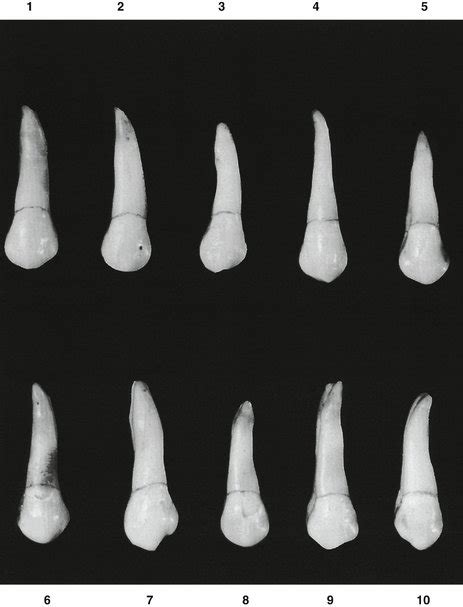 9 The Permanent Maxillary Premolars Pocket Dentistry