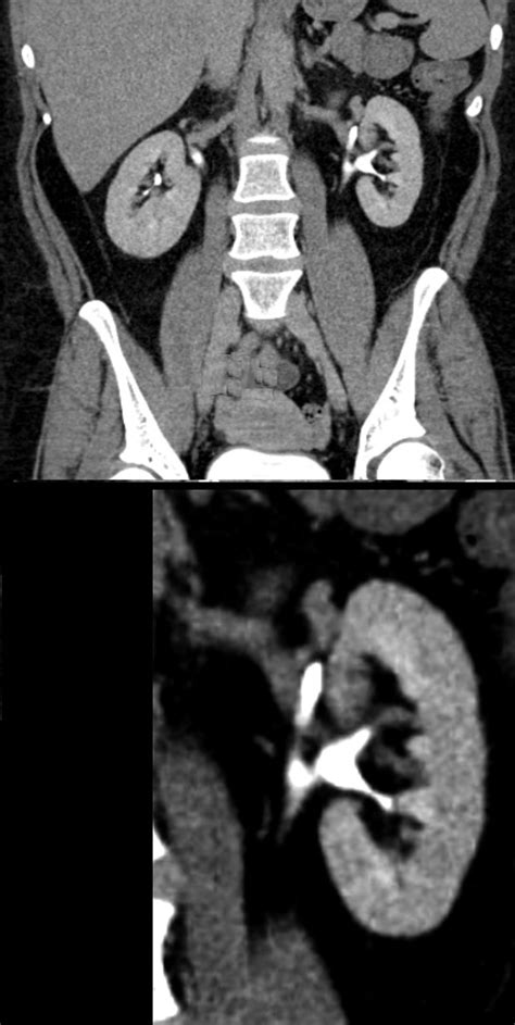 026k Partial Duplicated System And Column Of Bertin The Common Vein