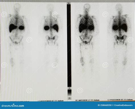 Indium Labeled Wbc Whole Body Scan Infected Right Prosthetic Knee