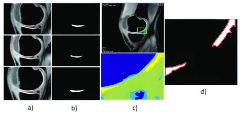 Example Of Segmentation Results For Articular Cartilage And Its