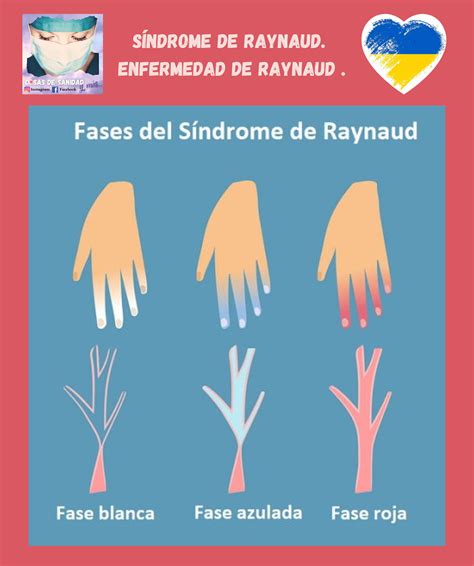 SÍndrome De Raynaud Enfermedad De Raynaud