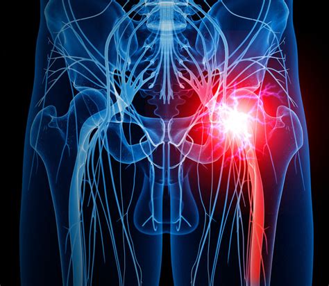 Acupuncture For Piriformis Syndrome