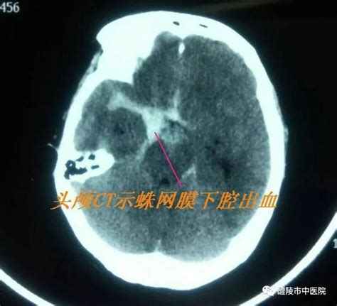 市中医院成功开展颅内动脉瘤介入栓塞术