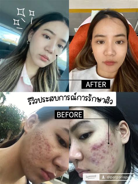 ️‍🩹รีวิวประสบการณ์การรักษาสิว 13ปี หายได้ 🏻 แกลเลอรีที่โพสต์โดย พอ