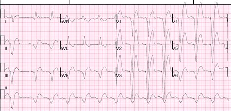 Great Chart Of Pediatric Ecg Intervals Qrs Qtc And Pr All Ages