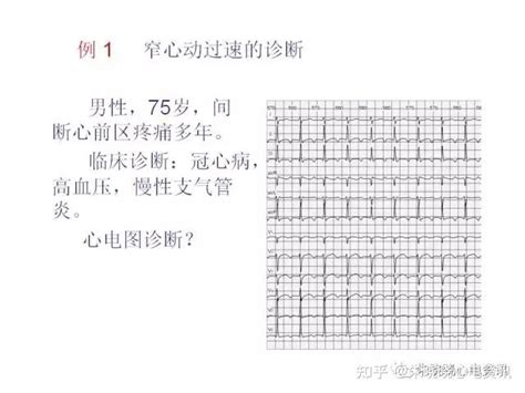 复杂心电图分析方法（ppt） 知乎