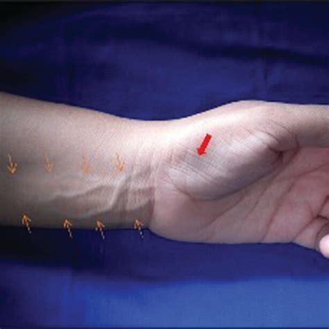 Intraoperative Photograph Showing The Enlarged Median Nerve With