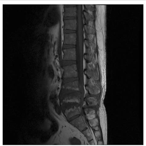 Hyperintensity Within The Intervertebral Discs Spaces Of L4 L5 And
