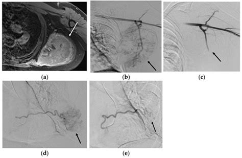 Transarterial Embolization And Percutaneous Ablation Of Primary And