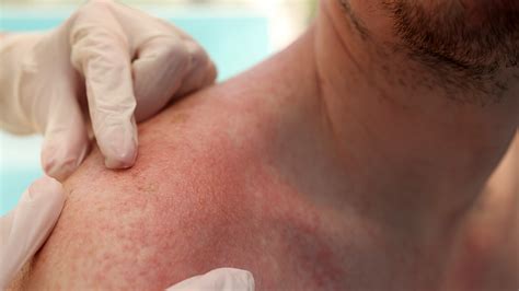 Sunburn Blisters Pictures Causes And Treatment Goodrx