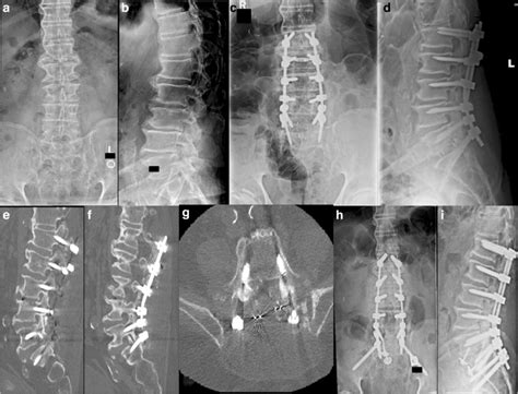 A Anteroposterior Ap And B Lateral Plain Radiographs Taken Before