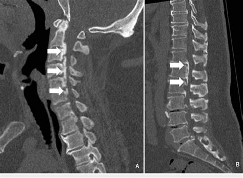 A Ossification Of The Posterior Longitudinal Ligament Opll In The