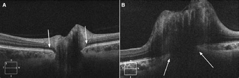 Bruchs Membrane Opening Angle Arrows In Pseudopapilloedema Appears