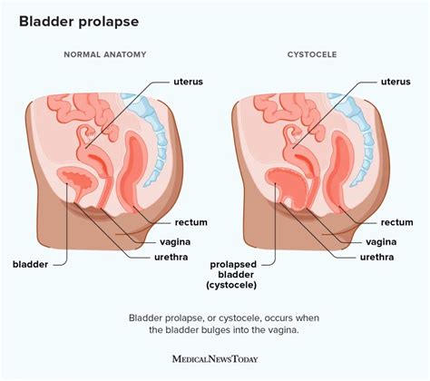 Bladder Prolapse Symptoms Stages And More