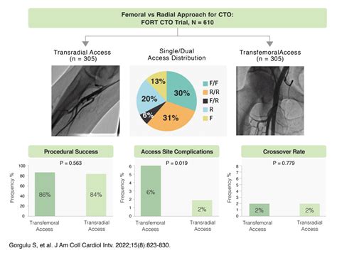 Radial Access For Complex Pci Terumo Interventional Systems