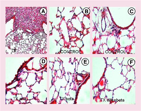 Histopathologic Analysis Of Lungs From Recombinant Defensin Treated