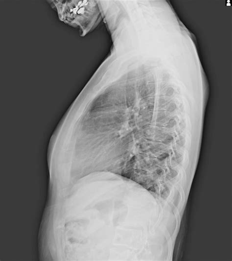 La Radiographie De Film De Scoliose Montre La Courbure De La Colonne