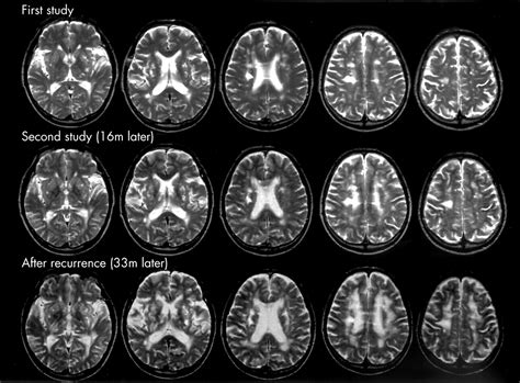 Stroke Vs Normal Brain Mri Mri Shows Brain Scars In Military