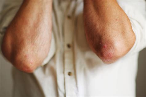 Psoriasis Am Ellenbogen Ein Mann Zeigt Einen Fokus Der Psoriasis Auf