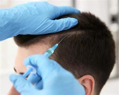 Prp Hair Treatment Malaysia Aesthetic Clinic Malaysia
