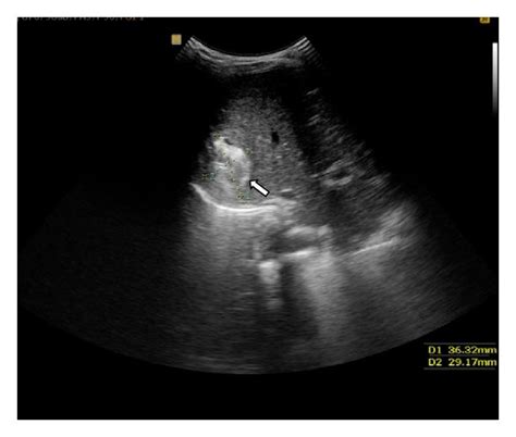 A Ct Shows A Simple 37 × 28 Cm Subcapsular Liver Cyst In Median Download Scientific Diagram