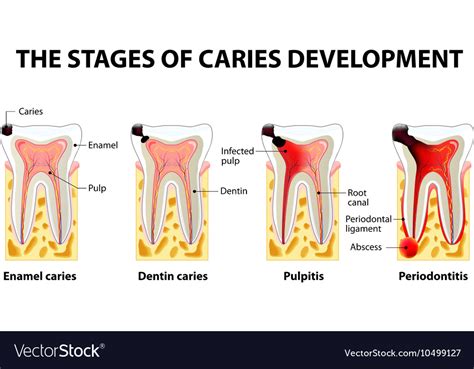 Dental Disease Caries Pulpitis And Periodontitis Vector Image