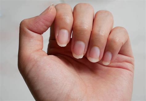 Unhas descamando por quê Causas tratamento e soluções caseiras