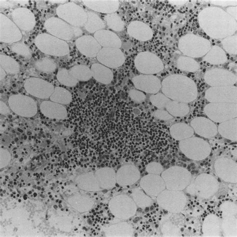 Pdf Lymphoid Aggregates In Bone Marrow Study Of Eventual Outcome