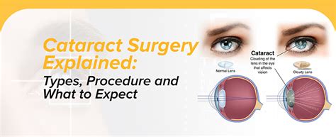 Cataract Surgery Explained Types Procedure And What To Expect